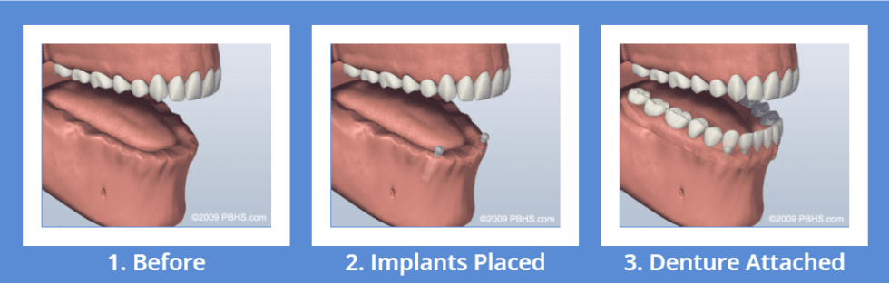 Implant Retained Dentures - Gilmer Family Dental